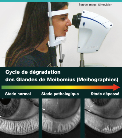 Traitement de la sécheresse oculaire : traitement oculaire - Clinique ...